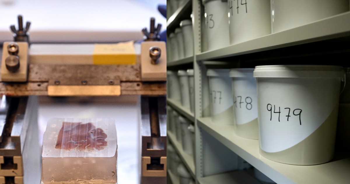 Grey area: chilling past of world's biggest brain collection • PhilSTAR ...