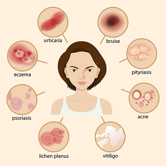 Skin disease can be a sign of internal cancer • PhilSTAR Life