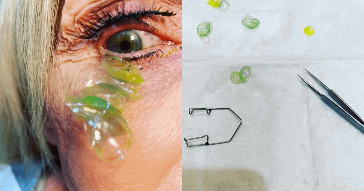 Eye doctor takes out 23 contact lenses out of patient's eye • PhilSTAR Life