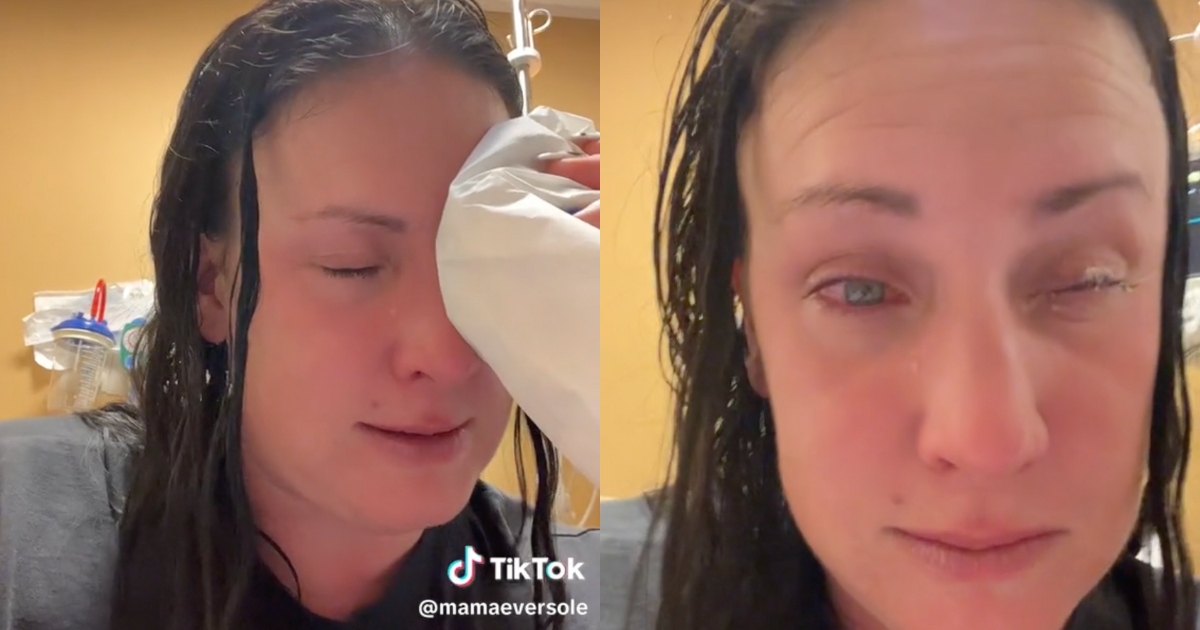 Woman goes viral after accidentally fusing her eye shut with superglue ...