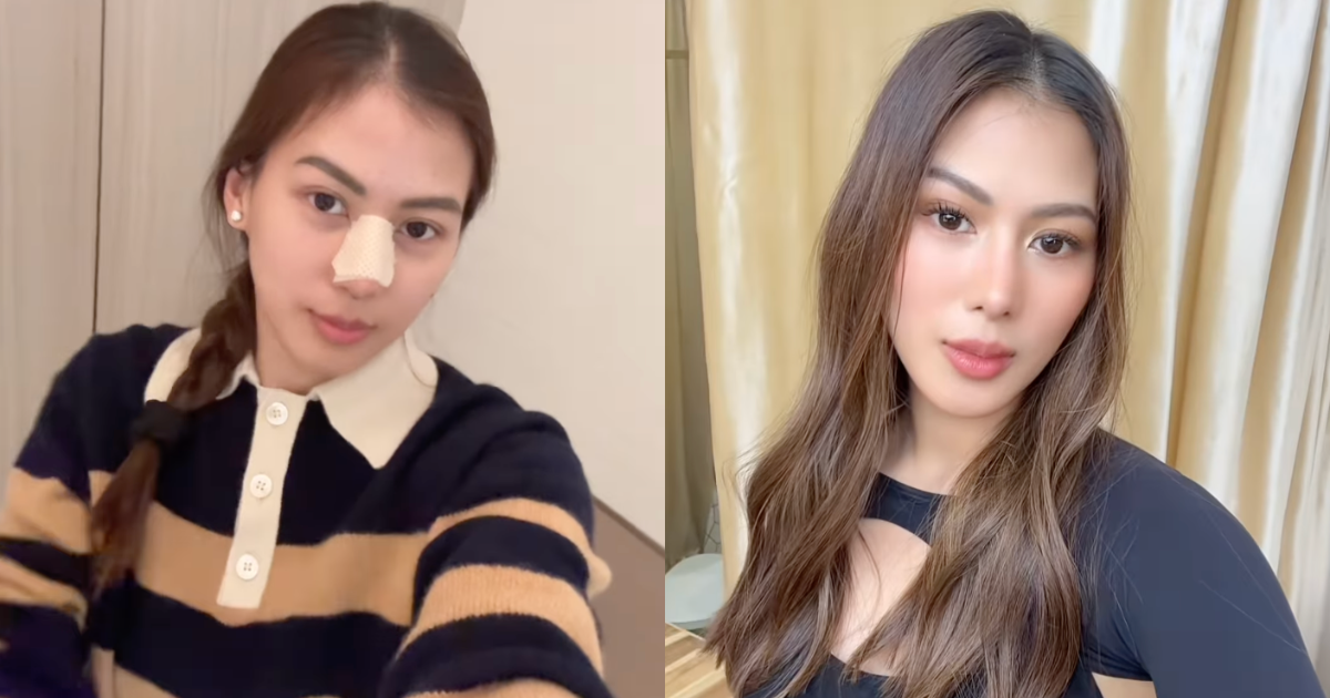 Alex Gonzaga shares she removed her nose implant • PhilSTAR Life