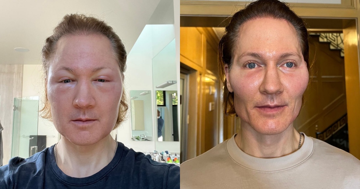Entrepreneur spends millions to reverse his aging, gets swollen face ...