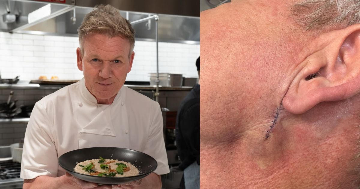 Gordon Ramsay undergoes surgery for skin cancer • PhilSTAR Life