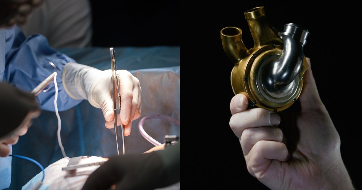Doctors successfully implant titanium heart in human patient for the ...